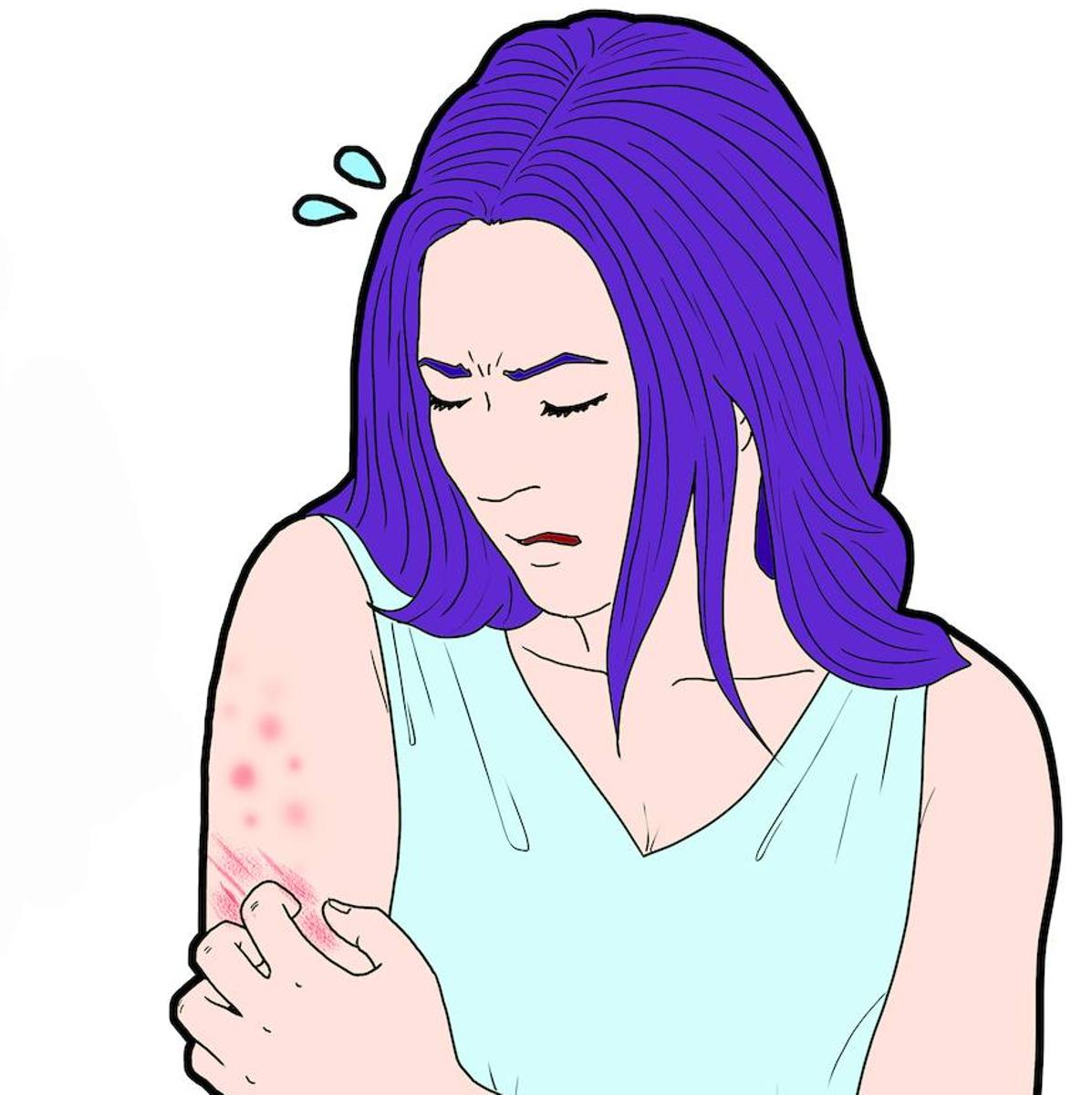 Urticaria Crónica O Cómo Convivir Con Las Ronchas Y El Picor A Diario